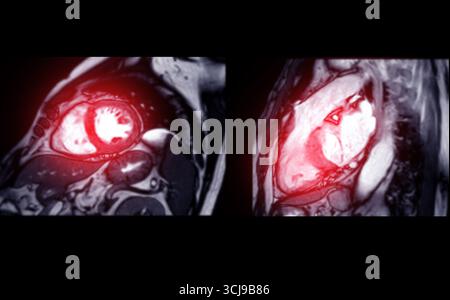 MRI heart stress test revealing detailed cardiac function under ...