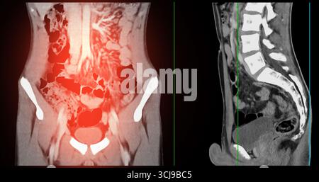High-resolution CT scan Lower abdomen showing a normal lower abdomen ...