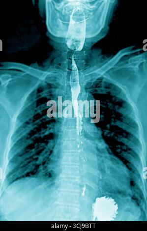Fluoroscopic footage of a barium swallow test showing real-time ...