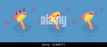 Urinary Incontinence, Illustration Stock Photo - Alamy