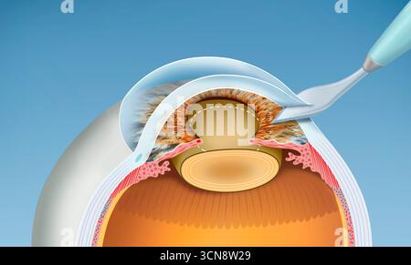 Cataract eye disease, illustration Stock Photo - Alamy