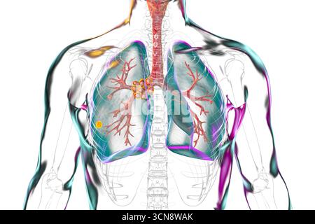 Primary lung tuberculosis with the Ranke complex. Computer illustration ...