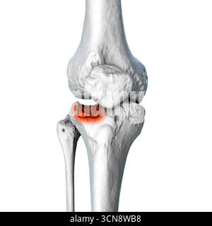 Tibia fracture Schatzker type III. Illustration showing pure depression ...