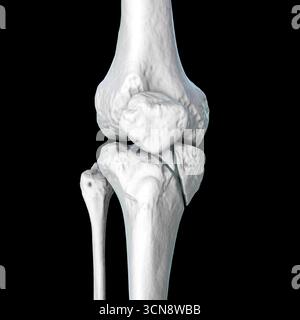 Tibia fracture Schatzker type IV. Illustration showing medial tibial ...