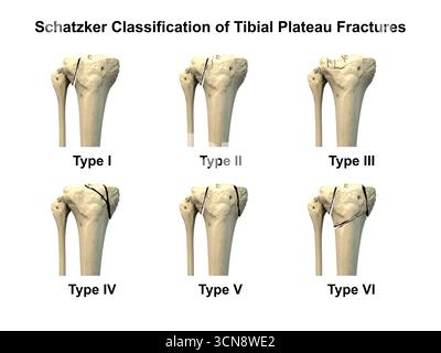 Illustration of the Schatzker classification of tibial plateau ...