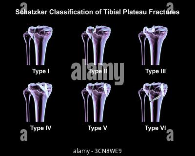 Illustration of the Schatzker classification of tibial plateau ...
