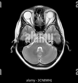 Magnetic resonance imaging of a patient with a temporal horn cyst of ...
