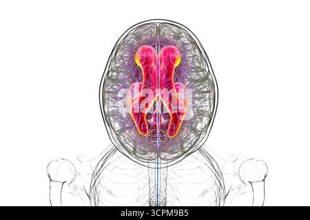 Human brain with normal pressure hydrocephalus, illustration showing ...