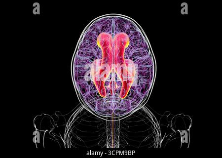 Human brain with normal pressure hydrocephalus, illustration showing ...