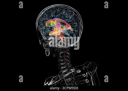 Illustration of enlarged lateral and third ventricles of the brain ...