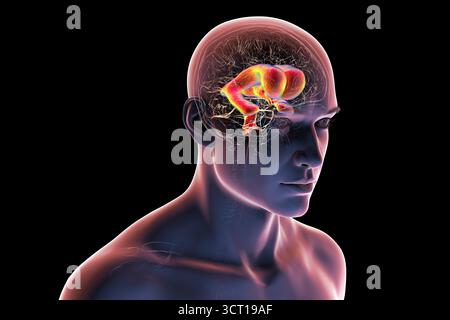 Illustration of a human brain with normal pressure hydrocephalus. This ...