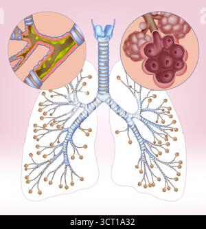 Bronchitis lung disease, illustration Stock Photo - Alamy