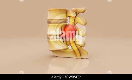 Conceptual 3D illustration of a herniated disk in the lumbar spine ...