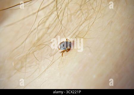 Zecke in Haut Stock Photo - Alamy