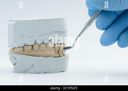 Gloved hand using dental tool on a stone tooth mold, illustrating ...