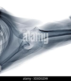 X-ray Shoulder joint shoulder transaxillary view for diagnosis fracture ...