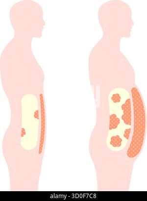 Subcutaneous and visceral fat diagram illustration Stock Vector Image ...