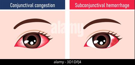 Illustration comparing subconjunctival hemorrhage and conjunctival ...