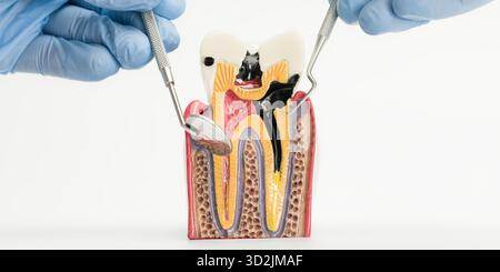 Tooth model showing advanced dental caries with cross section revealing ...