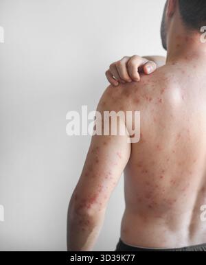 Red patches on the skin of the chest and abdomen in a young female ...