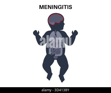 Illustration of meningitis. This is an inflammation of the protective ...