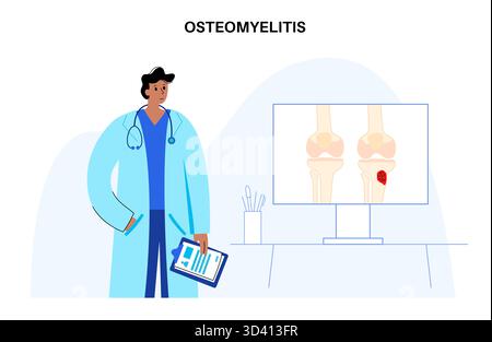 Illustration of tibia bone osteomyelitis. This is an infection of the ...