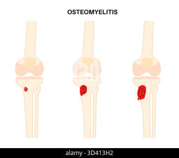 Illustration of tibia bone osteomyelitis. This is an infection of the ...
