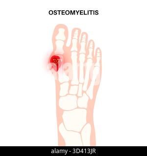 Illustration of foot bone osteomyelitis. This is an infection of a bone ...