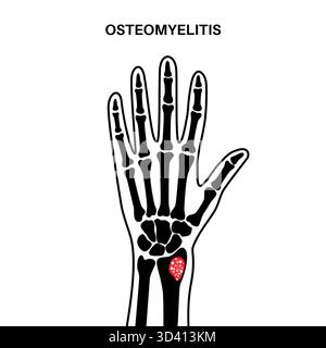 Illustration of arm bone osteomyelitis. This is an infection of the arm ...