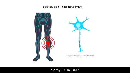 Illustration of peripheral neuropathy, a type of nerve damage in the ...