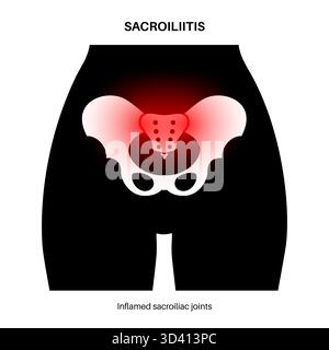 Illustration of sacroiliitis. This is an inflammatory condition that ...