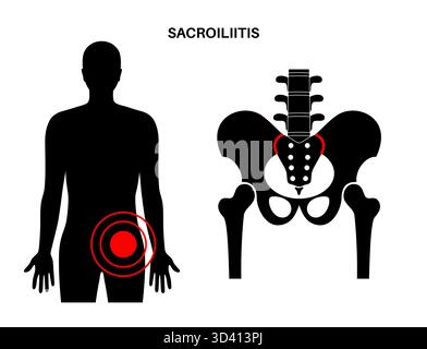 Illustration of sacroiliitis. This is an inflammatory condition that ...