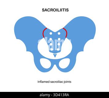 Illustration of sacroiliitis. This is an inflammatory condition that ...