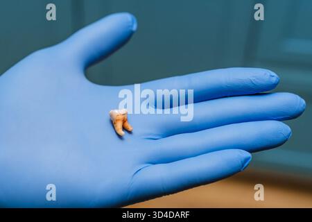 Human's tooth torn out after dentist surgery laying on the palm of the ...