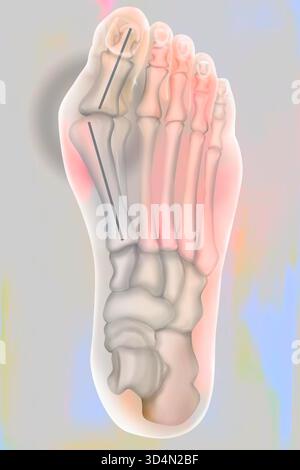 Hallux valgus bunion. Hallux valgus is an outward deviation of the big ...