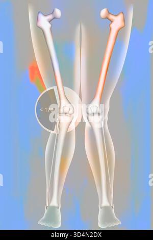 Genu valgum (knock knees Stock Photo - Alamy