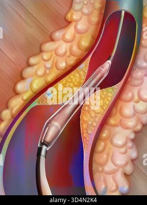 Angioplasty performed using a balloon catheter and a stent: balloon ...
