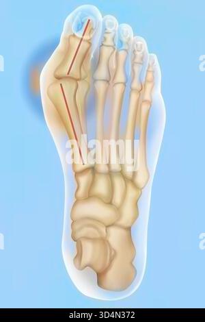 Hallux valgus bunion. Hallux valgus is an outward deviation of the big ...