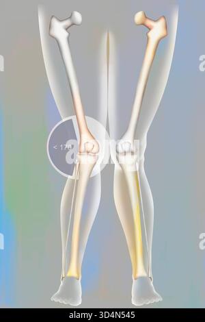 Genu valgum (knock knees Stock Photo - Alamy