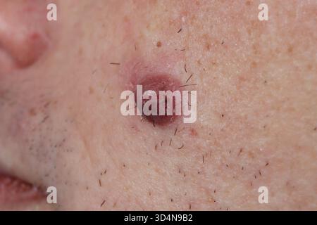 Benign dermal nevus of the cheek in a 37-year-old man Stock Photo - Alamy