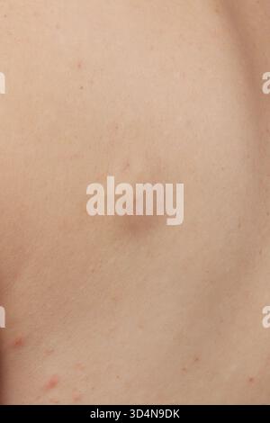 Sebaceous cyst of the back in a 42-year-old woman Stock Photo - Alamy