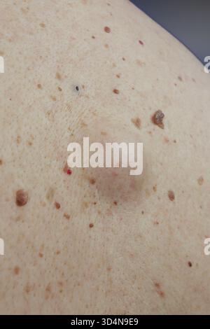 Sebaceous cyst of the back in an 85-year-old man Stock Photo - Alamy