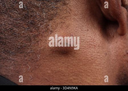 Cervical sebaceous cyst in a 63-year-old man Stock Photo - Alamy