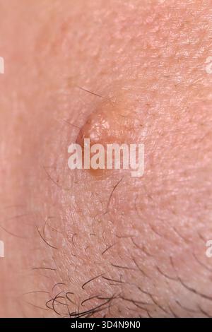 Benign tuberous dermal nevus of the forehead in a 29-year-old woman ...