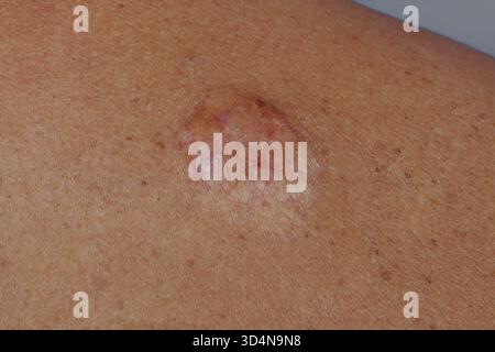 Infiltrating dorsal basal cell carcinoma in a 60-year-old woman Stock ...