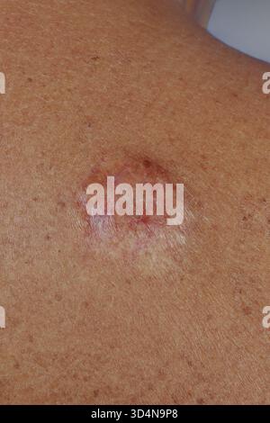 Infiltrating dorsal basal cell carcinoma in a 60-year-old woman Stock ...