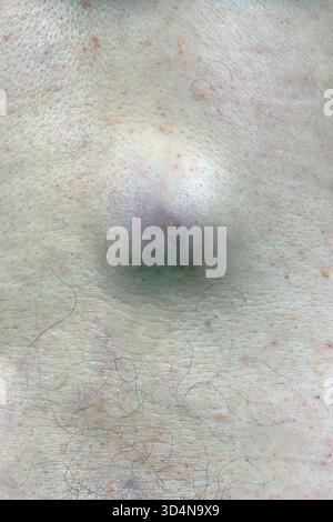Sebaceous cyst of the back in a 71-year-old man Stock Photo - Alamy