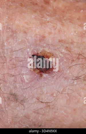 Squamous cell carcinoma of the back of the hand in an 86-year-old man ...