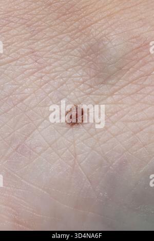 Atypical nevus in a 32-year-old woman Stock Photo - Alamy