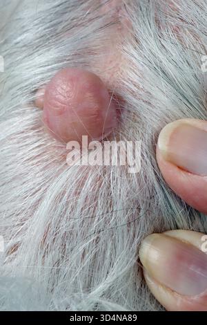 Neurofibroma on the skin of a 70-year-old man. Neurofibroma growths ...